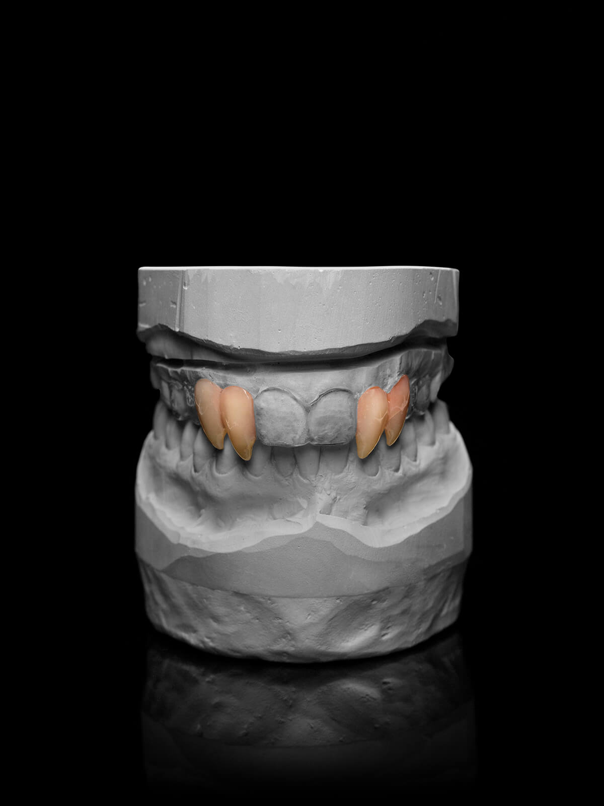 fx teeth systems we use - alphabite
